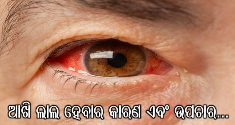 why your eye becomes red and know its remedies